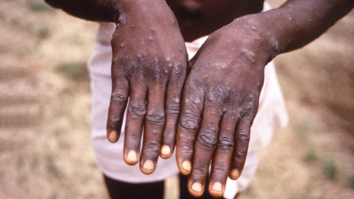 Affenpocken: Warum uns immer wieder Zoonosen heimsuchen - WWF Blog